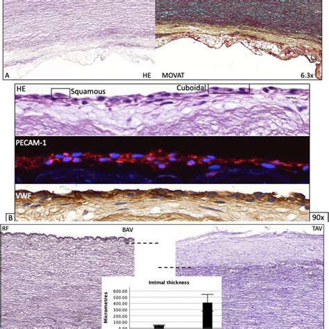 Transverse Histologic Sections Of A Non Dilated Ascending Aortic