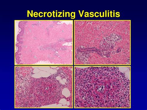 Ppt Treating Difficult Patients Of Renal Vasculitis Powerpoint