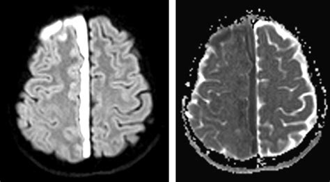 Subdural Empyema Radiology Cases
