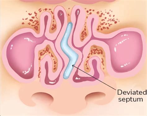 Nasal Septal Deviation Causes Types Clinical Features