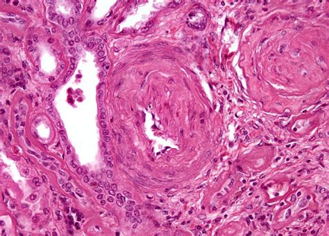 Hyperplastic Arteriosclerosis At 20x Magnification Microscopyu