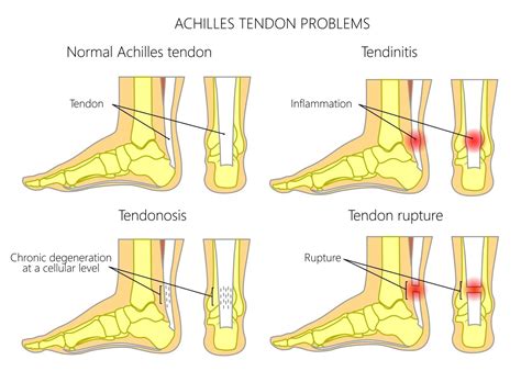 How To Treat Extensor Tendonitis Foot Extensor Tendonitis Foot