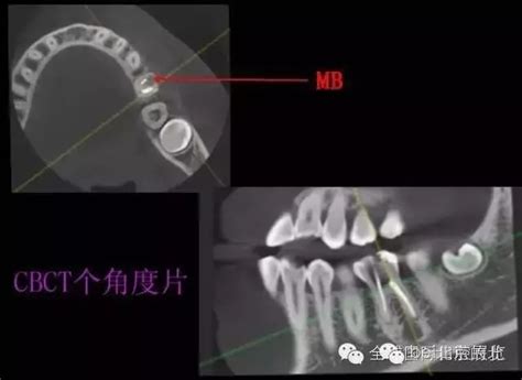 下颌第一磨牙近中3根管的治疗 牙体牙髓 陕西嘉友科贸有限公司