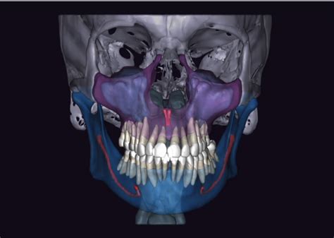 論文レビュー Segmentation Of Temporomandibular Joint Structures On Mri