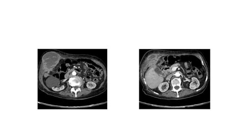 Right Hypochondrial Massespptx