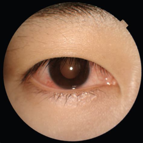 Angular Blepharoconjunctivitis