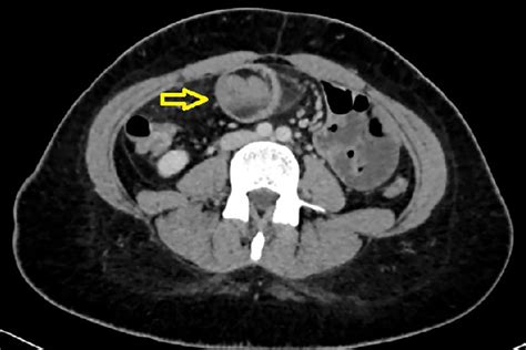 Intussusception In The Distal Jejunal Loops On Abdominal Tomography