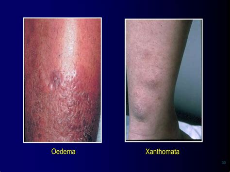 Thyroid Disorders Hyperthyroidism And Hypothyroidism Pdf