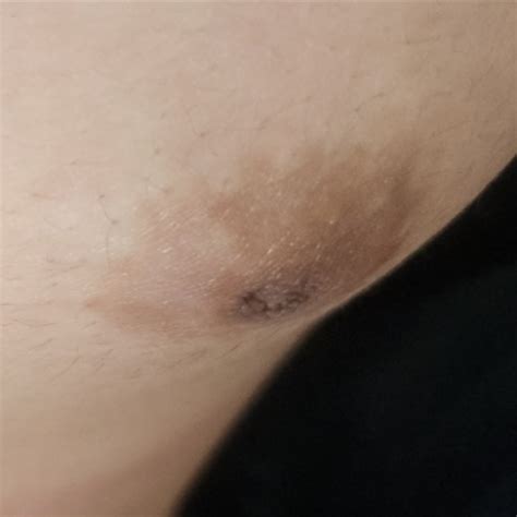 이거 곤지름 성병인가요 지식in