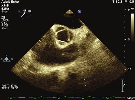 Short Axis View Of Aortic Valve In Midesophageal Window 47° View Of