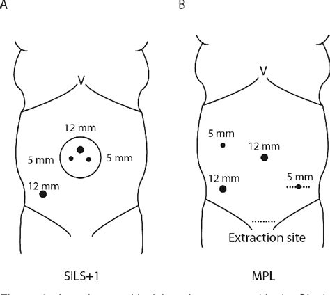 Table 2 From Single Incision Plus One Port Versus Standard Multiport Laparoscopic Surger Y For