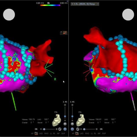 First Time Pulmonary Vein Isolation Pre Ablation And Post Ablation