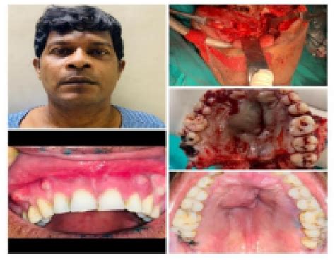 Total Maxillectomy Done In Patient With Bilateral Maxillary Sinus
