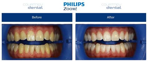 Cosmetic Teeth Whitening Treatment Townsville Zoom Whitening Dentist Townsville