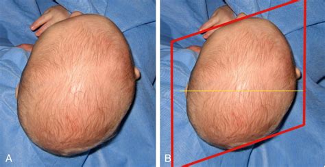 Lambdoid Craniosynostosis Neupsy Key