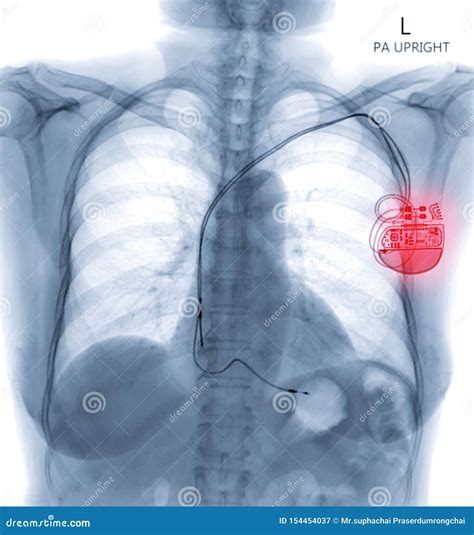 Chest X Ray Or X Ray Image Of Human Chest With Pacemaker Placement