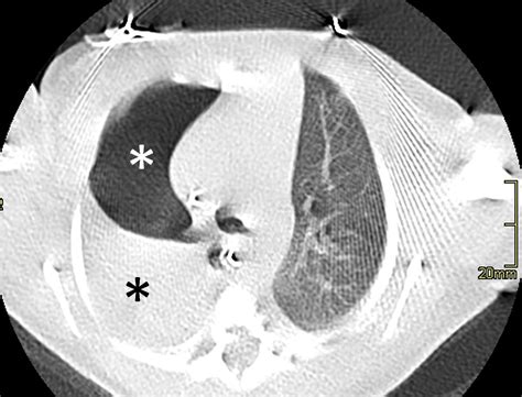 Pneumothorax And Atelectasis Appearing As A Non Specific Opacity On A