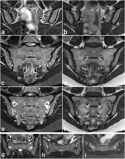 Si Joint Mri Scan