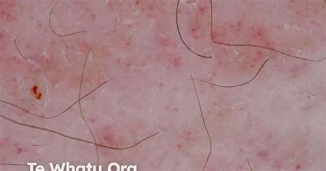 Dermoscopy Of Capillaritis Image