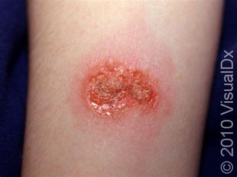 Impetigo Causes Symptoms And Treatment Skinsight