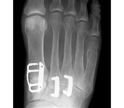 Lapiplasty® Speedplate® Treace