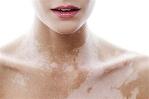Vitiligo Wenn Weiße Flecken Das Leben Bestimmen Wwer