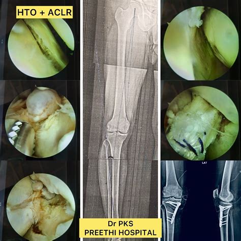 Hto With Aclr Dr Prahalad Kumar Singhi