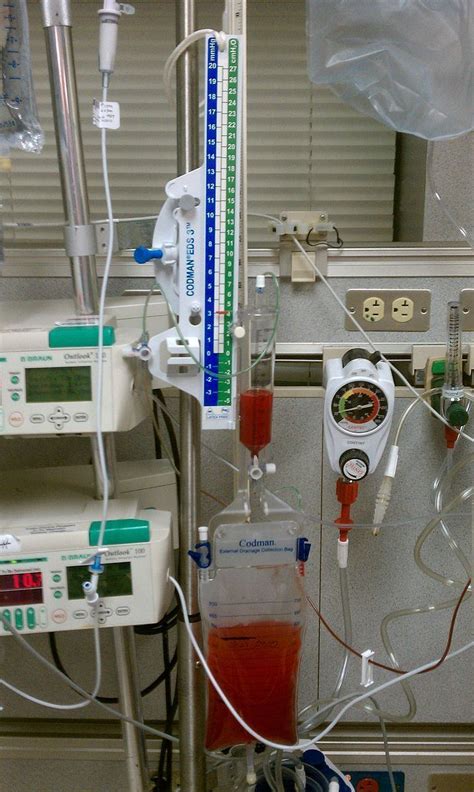 External Ventricular Drain Alchetron The Free Social Encyclopedia