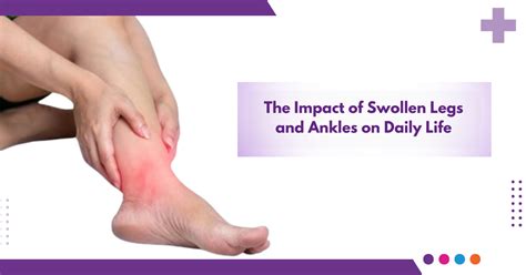 The Impact Of Swollen Legs And Ankles On Daily Life