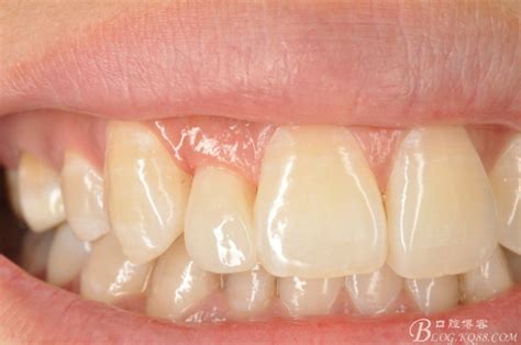 瓷睿刻 CEREC 个性化铸瓷无备牙贴面 种植牙医 李喆的博客 KQ88口腔博客
