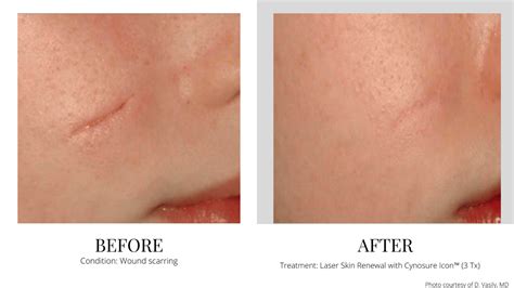 Laser Scar Removal Revolutionary Medical Lasers In Marina Bay Quincy