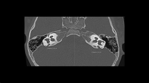 Vestibular Aqueduct Enlarged Vestibular Aqueduct Syndrome Eurorad