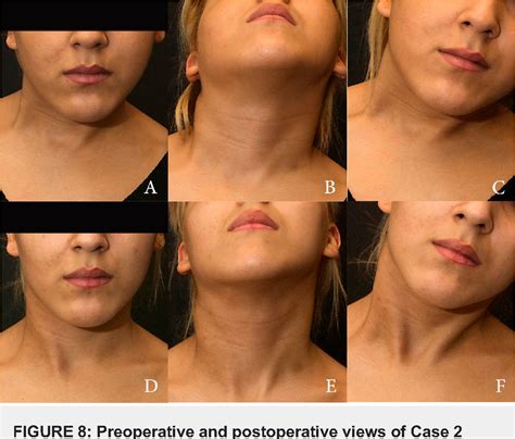 Torticollis In Adults