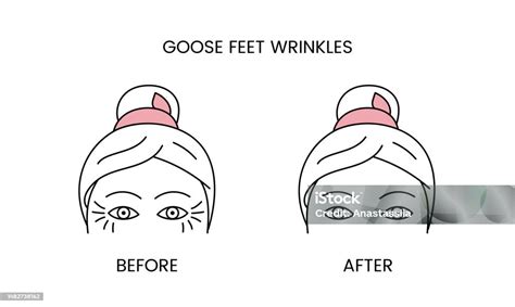 거위 발 주름 시술 전과 벡터에 치료 라인 아이콘을 적용한 후의 레이저 미용 매끄럽고 깨끗한 피부와 문제성 피부를 가진 여성의