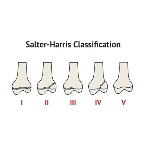 Salter Harris Classification Of Fractures Classification Human Body Anatomy Topic Outline
