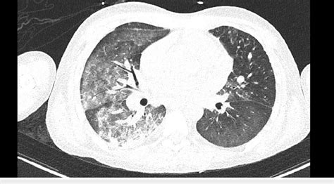 Computerised Tomograph Of The Chest Showing Diffuse Alveolar