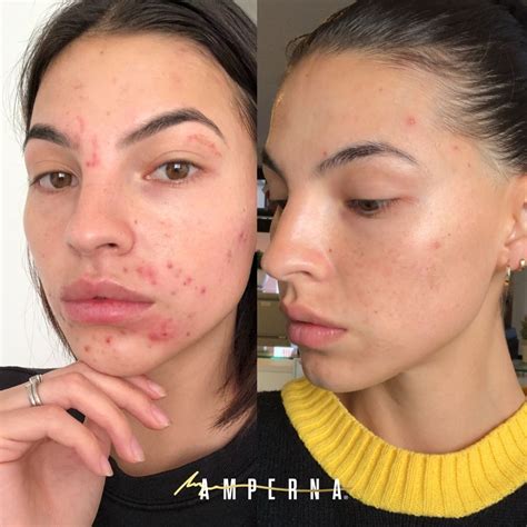 Acne Plus Topical Probiotics For Acne Amperna®