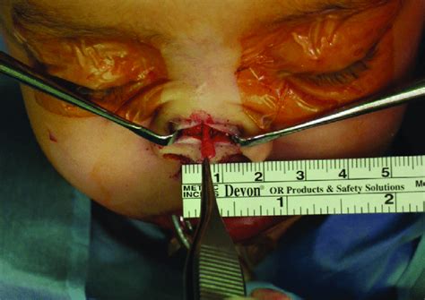 Intraoperative Findings In The Process Of Excision Intracranial Tract