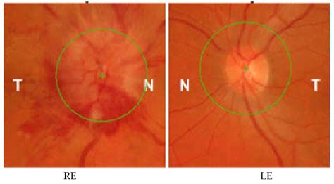 The Optic Nerve During The Fundus Examination With Papillary Edema Download Scientific Diagram