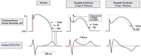 Schematic Representation Of The Repolarisation Disorder Hypothesis