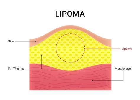 Premium Vector Lipoma Illustration Human Skin Cross Section