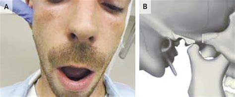 Repositioning Dislocated Temporomandibular Joints Nejm