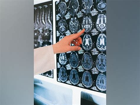 Brain Flexibility May Hasten Hearing Improvements From Cochlear Implants Theprint Anifeed