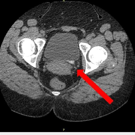 Dmsa Scan Showing Homogenous Isotope Uptake Without Focal Scarring Seen