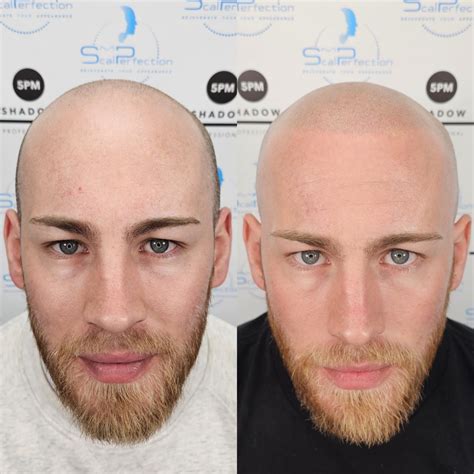Reclaim Your Style Solutions For Male Pattern Baldness