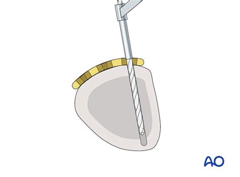 Compression Plating For Extraarticular Fracture Of The Proximal End Segment