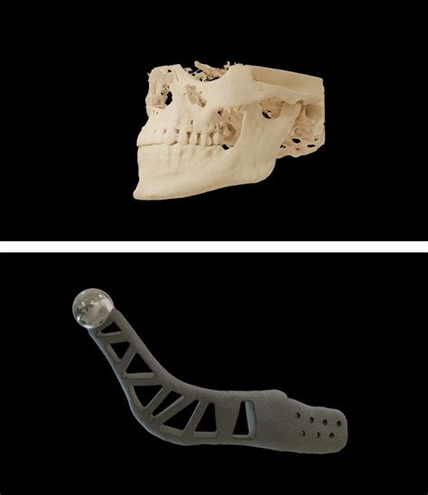 Matin Rezaei Balouchi On Linkedin Reconstruction Of Mandibular Defect By Patient Specific