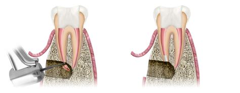 Root Apex Resection Cichoń Dental Centre