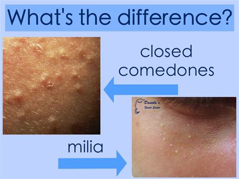 Open Vs Closed Comedones
