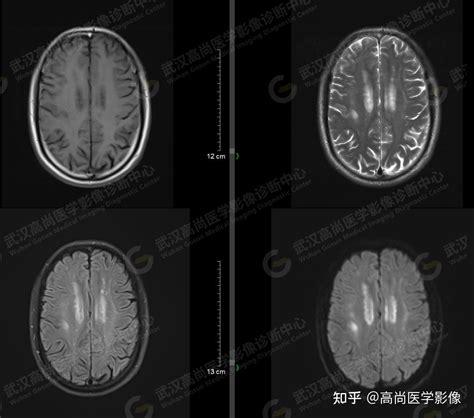因常年酗酒出现精神恍惚磁共振诊断胼胝体进行性变性一例高尚医学影像 知乎